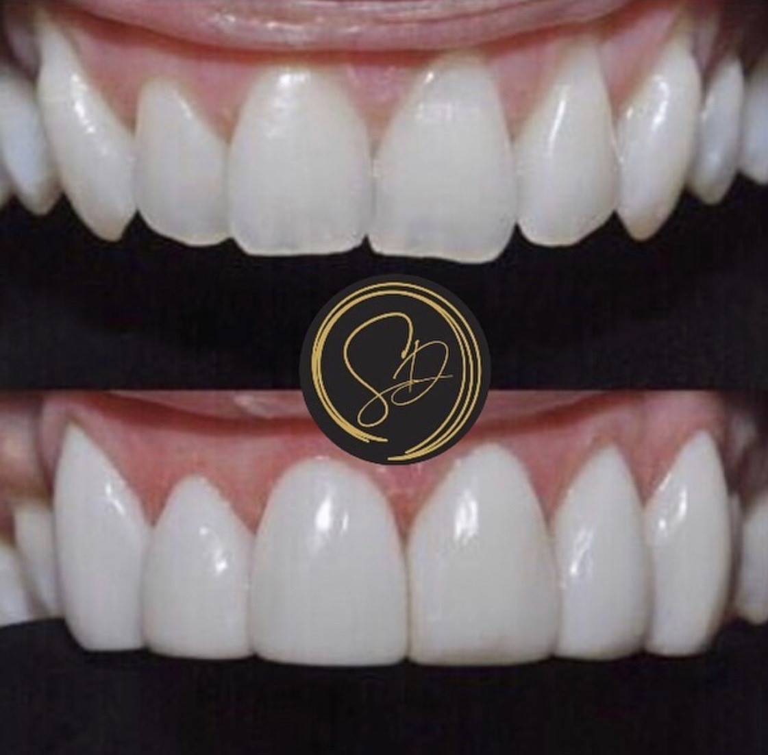 Essential guide to Composite Veneers - Shine